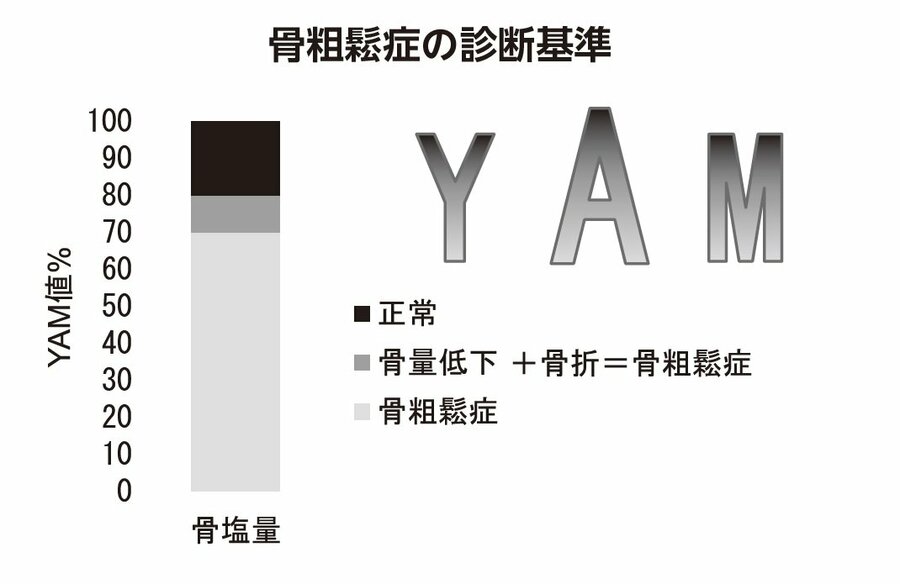 あなたは自分の骨密度を知ってる？骨の健康を示すバロメーター「YAM値」とは ｜ ゴールドライフオンライン